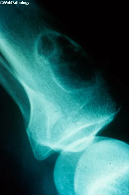 Non-Ossifying Fibroma (Metaphyseal Fibrous Defect)