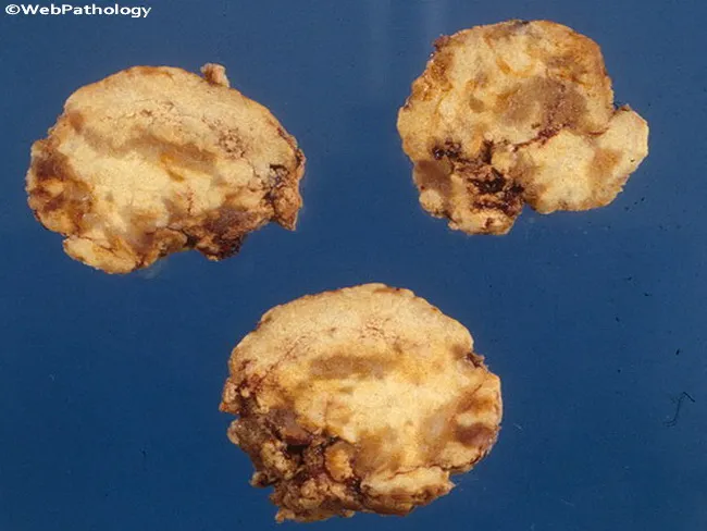 Non-Ossifying Fibroma (Metaphyseal Fibrous Defect)