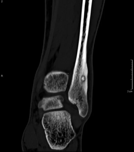 osteomas radiology