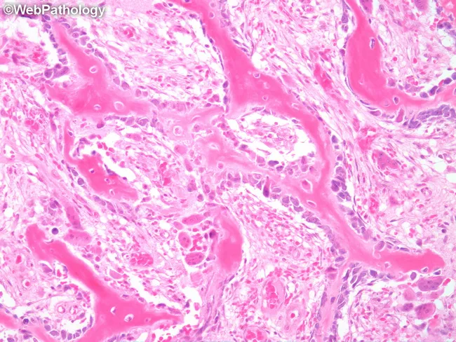 Osteoid Osteoma: Microscopic Features