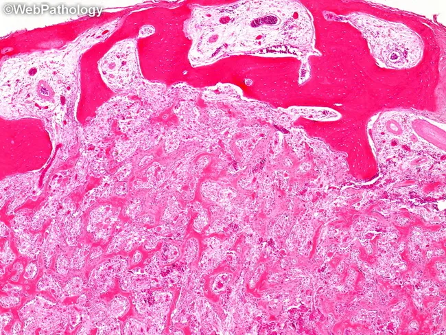 Osteoid Osteoma: Microscopic Features