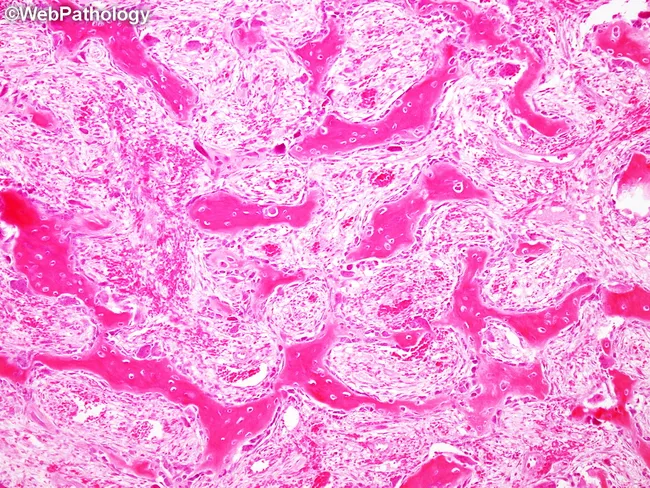 Osteoid Osteoma: Microscopic Features