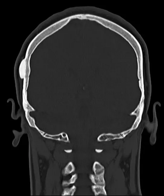 Osteoma: Imaging