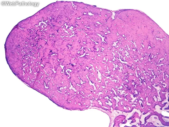 Osteoma: Microscopic Features