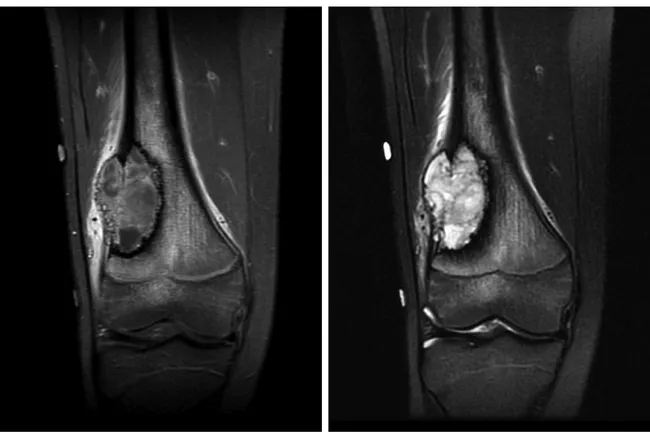osteosarcoma knee mri
