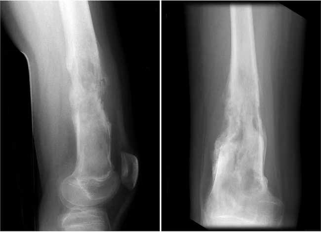 Osteosarcoma: Radiographic Features