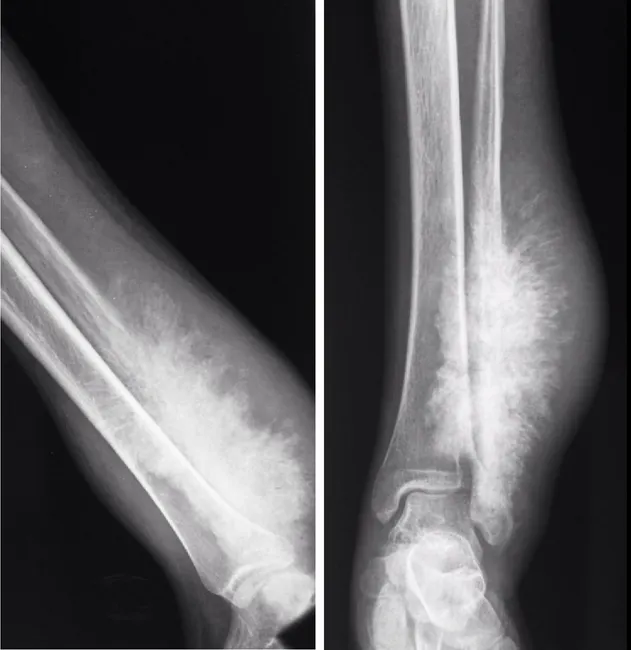 osteosarcoma shin bone
