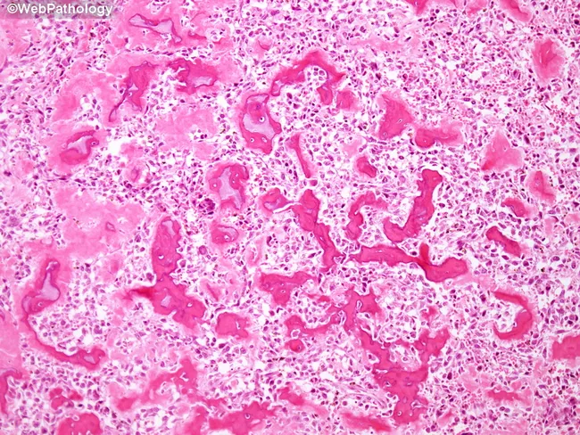 Osteosarcoma: Microscopic Features