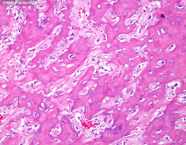 Osteoblastic Osteosarcoma