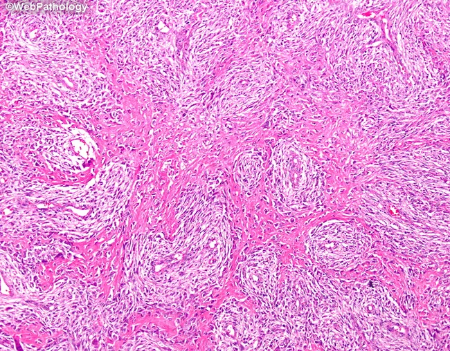 Fibroblastic Osteosarcoma