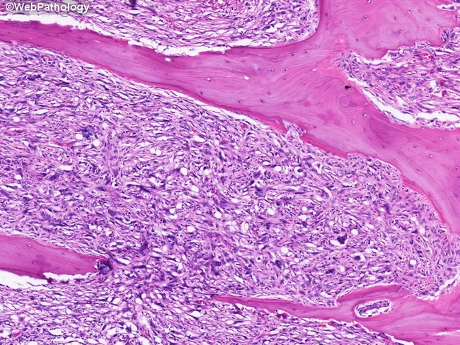 osteomalacia bone histology