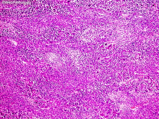 Osteosarcoma: Grading