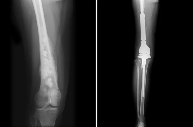 osteosarcoma knee
