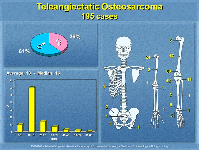 Telangiectatic Osteosarcoma: Introduction
