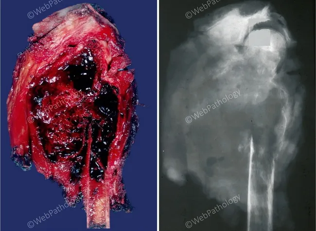Telangiectatic Osteosarcoma: Gross Pathology