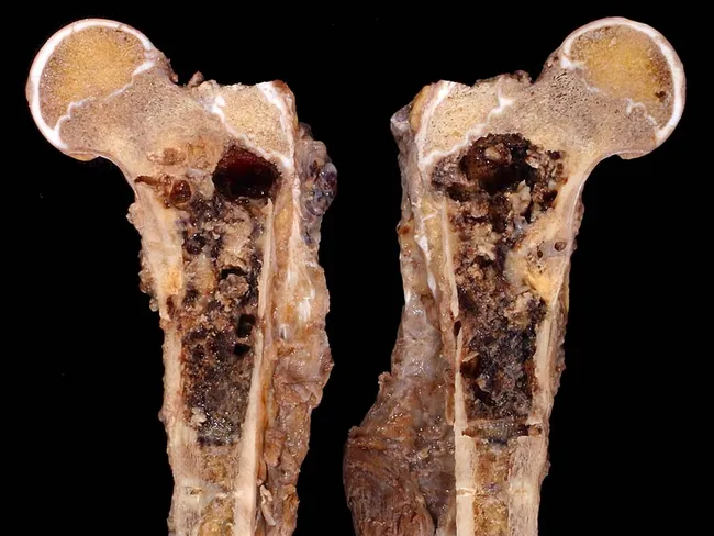 Telangiectatic Osteosarcoma: Gross Pathology