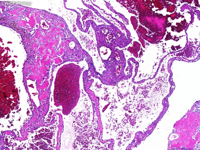 Telangiectatic Osteosarcoma: Microscopic Features