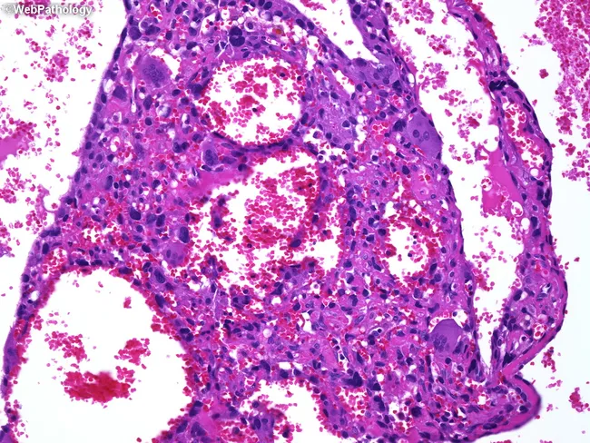 Telangiectatic Osteosarcoma: Microscopic Features