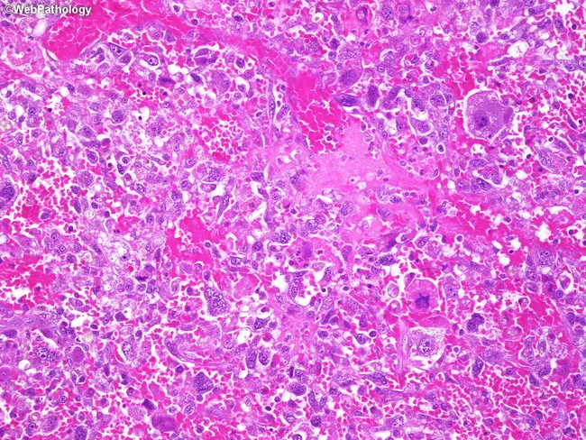 Telangiectatic Osteosarcoma: Microscopic Features