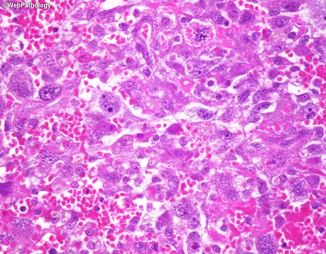 Telangiectatic Osteosarcoma: Microscopic Features
