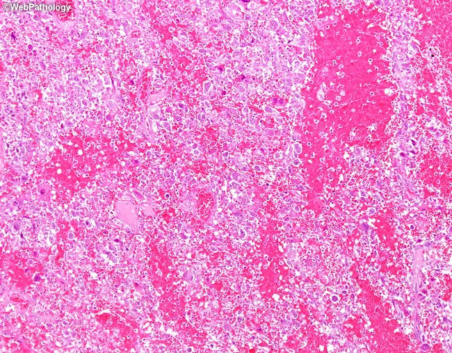 Telangiectatic Osteosarcoma: Microscopic Features