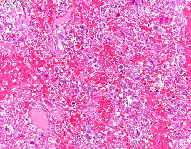 Telangiectatic Osteosarcoma: Microscopic Features