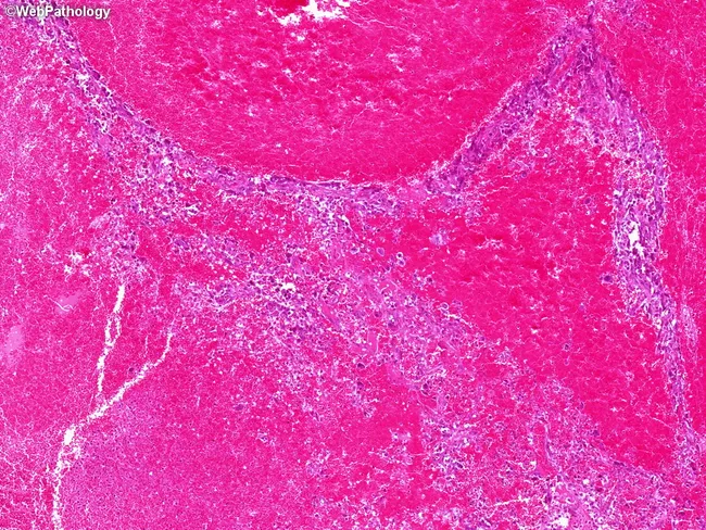 Telangiectatic Osteosarcoma: Microscopic Features