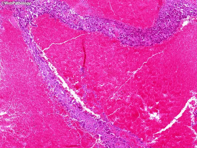 Telangiectatic Osteosarcoma: Microscopic Features