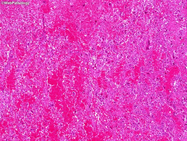 Telangiectatic Osteosarcoma: Microscopic Features