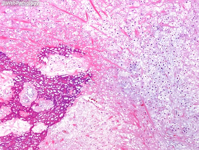 Osteosarcoma of the Jaw: Microscopic