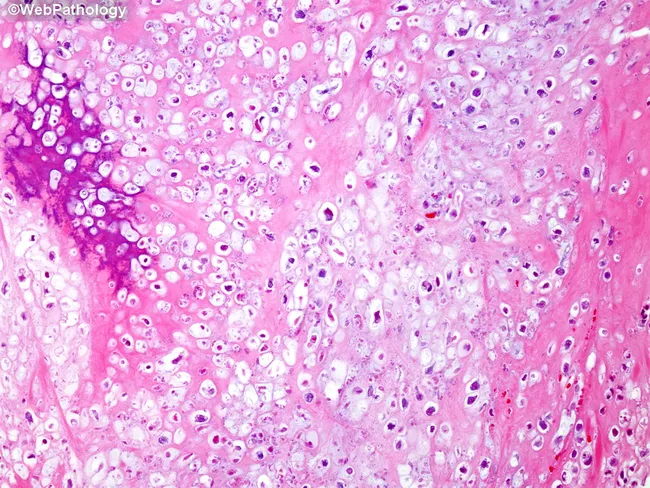 Osteosarcoma of the Jaw: Microscopic