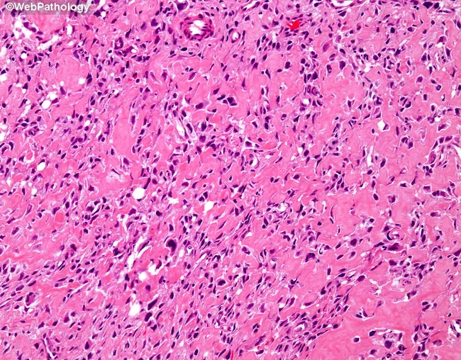 Osteosarcoma of the Jaw: Treatment