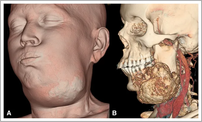 osteosarcoma jaws