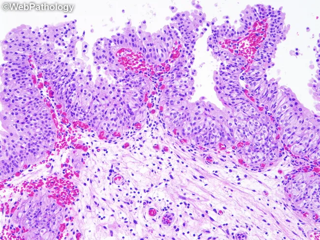 Papillary Urothelial Hyperplasia