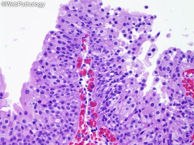 Papillary Urothelial Hyperplasia