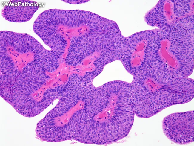 Papillary Urothelial Neoplasm of LMP