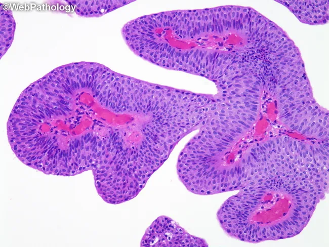Papillary Urothelial Neoplasm of LMP