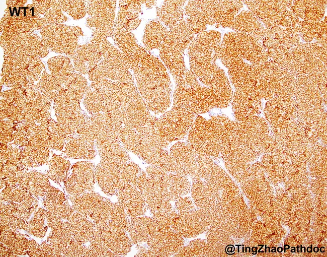 Wilms Tumor: WT1