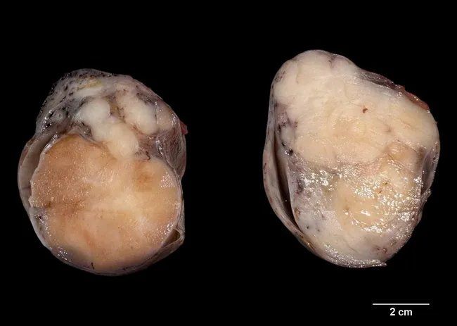 Paratesticular Embryonal Rhabdomyosarcoma