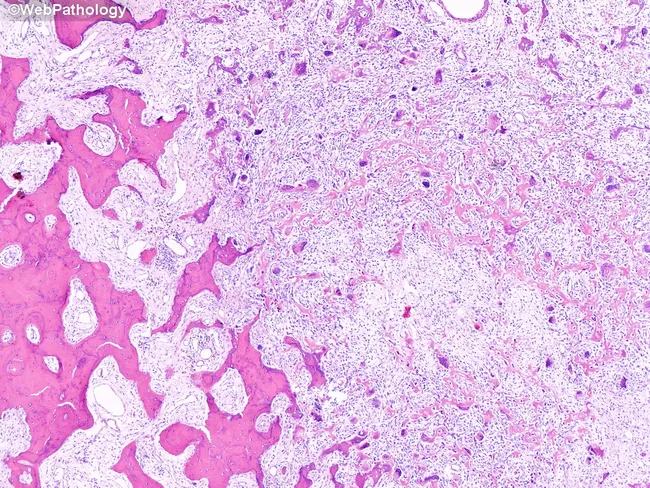 Osteosarcoma in Paget Disease of Bone