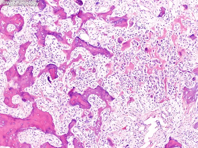 Osteosarcoma in Paget Disease of Bone