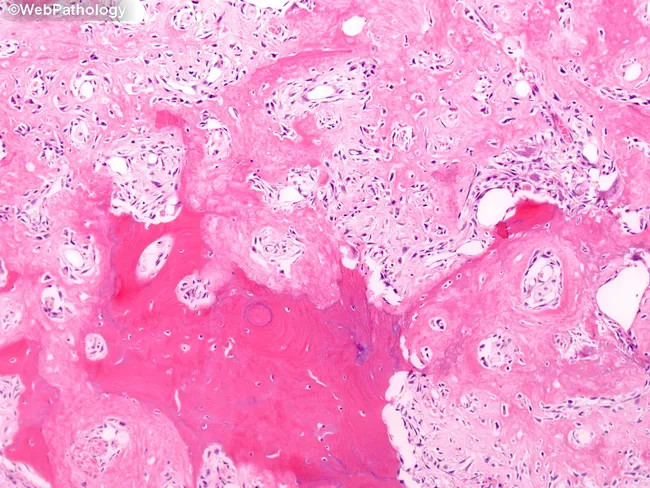 Osteosarcoma in Paget Disease of Bone