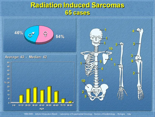 Radiation-associated Osteosarcoma