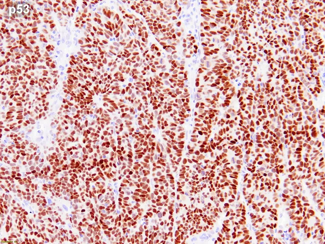High Grade Serous Carcinoma: p53