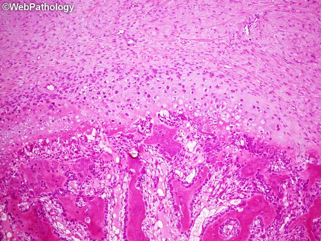 Subungual Exostosis: Microscopic Features