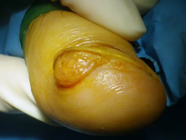 Subungual Exostosis: Clinical Features