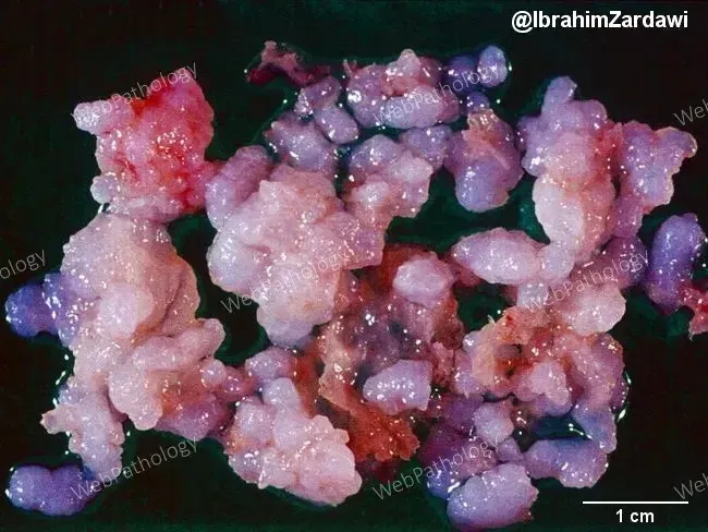 Synovial Chondromatosis: Gross Pathology