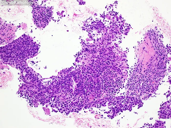 Mucoepidermoid Carcinoma of Thymus