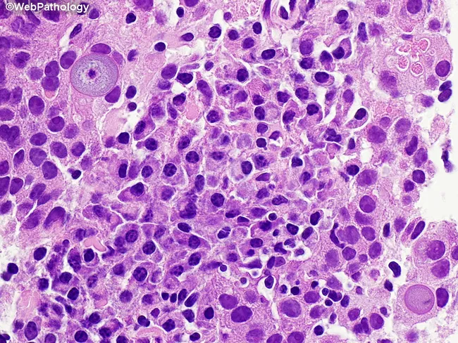 Mucoepidermoid Carcinoma of Thymus