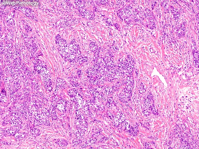Clear Cell Carcinoma of Thymus